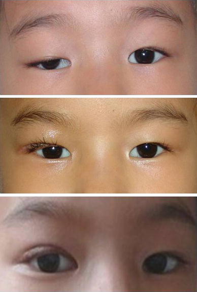 Frontalis Muscle Flap Advancement for Correction of Severe Ptosis Under ...