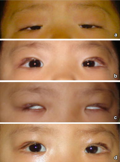 Frontalis Muscle Flap Advancement for Correction of Severe Ptosis Under ...