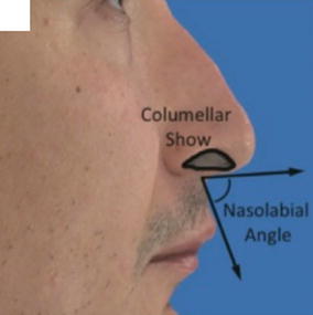 Alar-Columellar and Lateral Nostril Changes Following Tongue-in-Groove ...