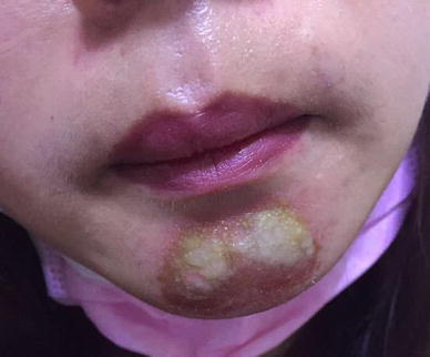 Vascular Complications After Chin Augmentation Using Hyaluronic Acid ...