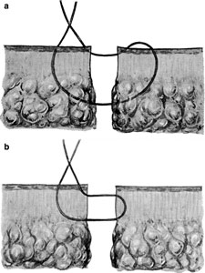 Mario Donati and the Vertical Mattress Suture of the Skin | SpringerLink