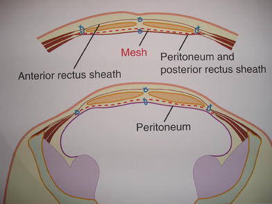 Open Mesh Repair of Incisional Hernia Using a Sublay Technique: Long ...