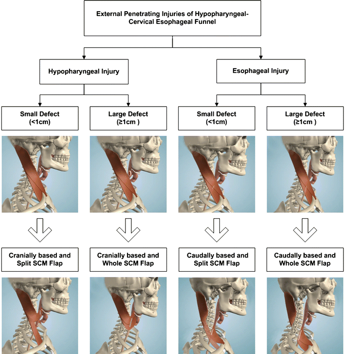 The Sternocleidomastoid Muscle Flap: A Versatile Local Method for ...