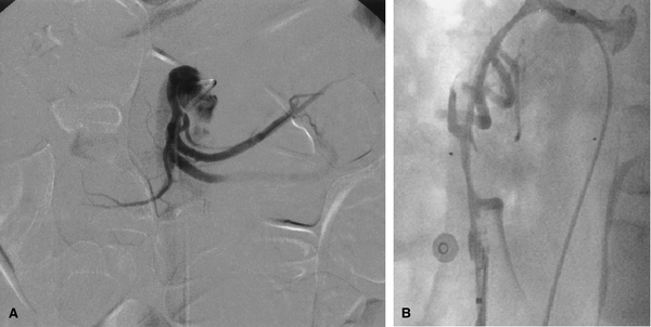 Successful Treatment of Isolated Spontaneous Superior Mesenteric Artery ...