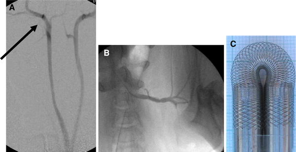 Carotid Artery Stenting Using a Novel Self-Expanding Braided Nickel ...