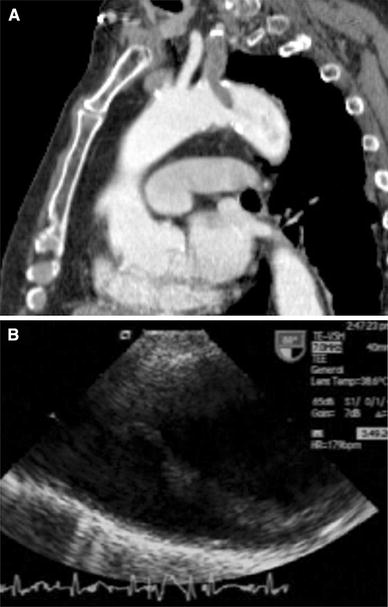 Acute Left Arm Ischemia Associated with Floating Thrombus in the ...