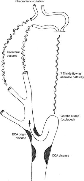 Carotid Stump Syndrome: Pathophysiology and Endovascular Treatment ...