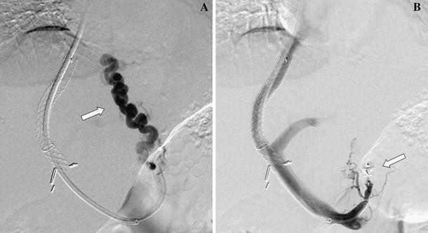 The Amplatzer Vascular Plug: A Review of the Device and its Clinical ...