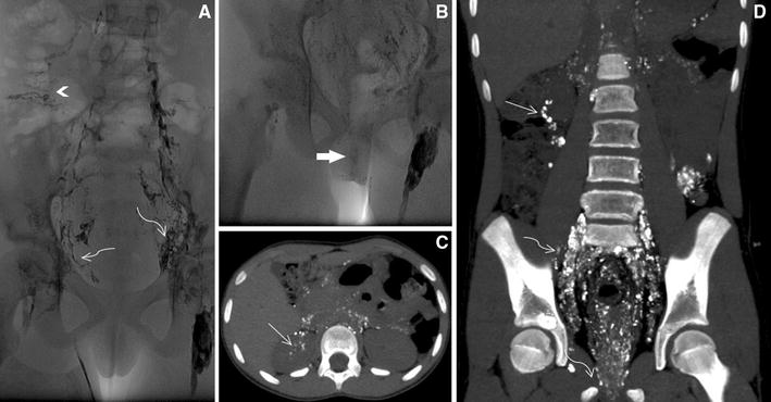 Transnodal Lymphangiography in the Diagnosis and Treatment of Genital ...