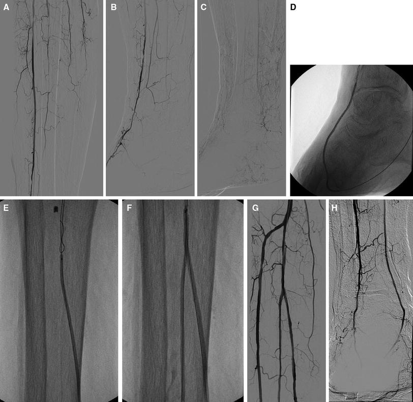 Endovascular Treatment of Diabetic Foot in a Selected Population of ...