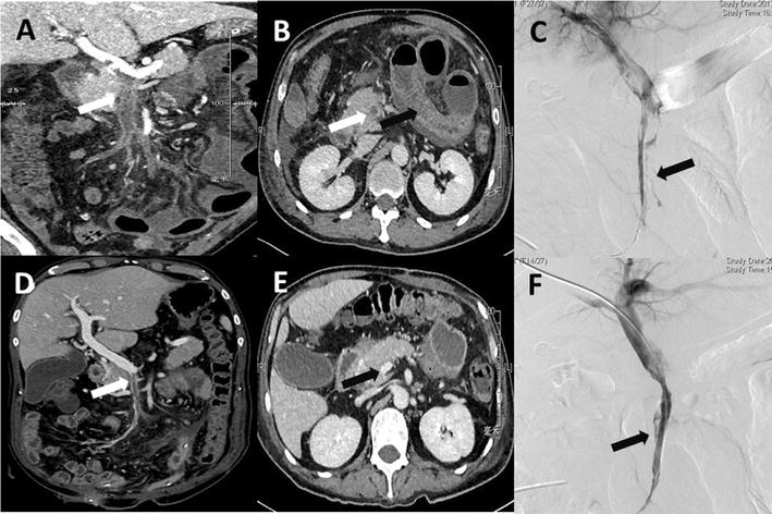 Acute Superior Mesenteric Venous Thrombosis: Transcatheter Thrombolysis ...