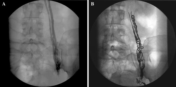 Female Pelvic Vein Embolization: Indications, Techniques, and Outcomes ...