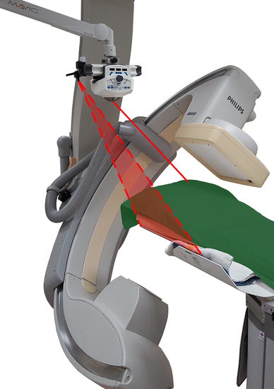 Laser Guidance in C-Arm Cone-Beam CT-Guided Radiofrequency Ablation of ...