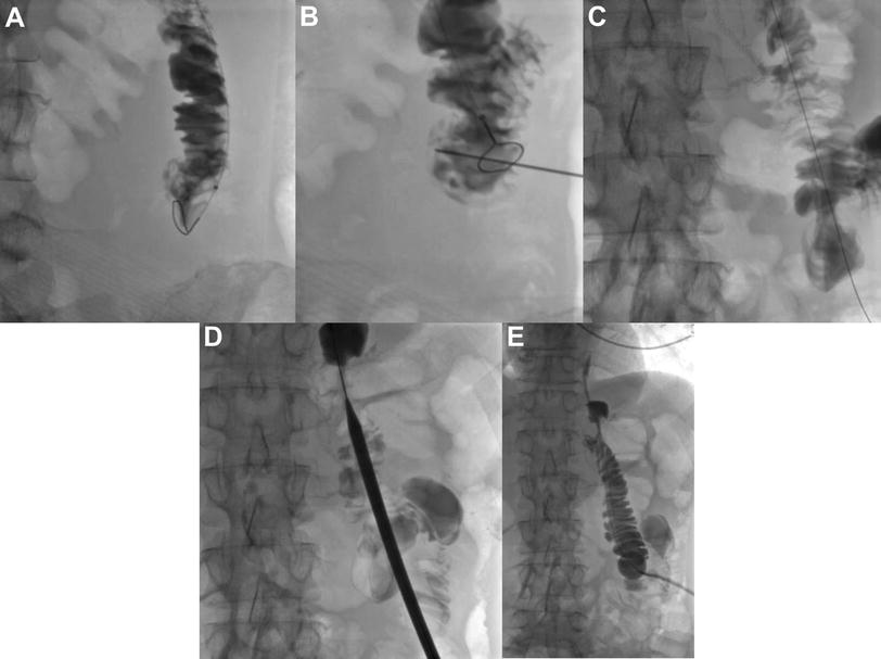 Transnasal Snare Technique for Retrograde Primary Jejunostomy Placement ...
