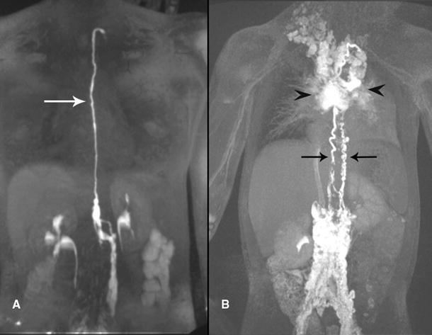 Modern Techniques of Lymphangiography and Interventions: Current Status ...