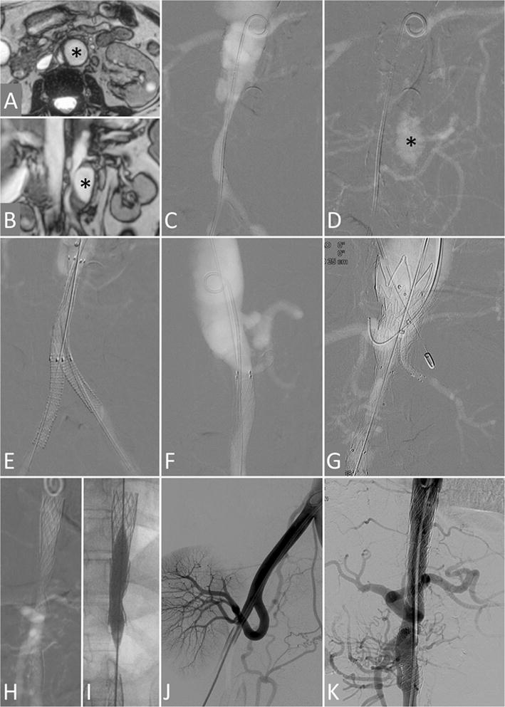 Carbon dioxide Angiography-Guided Renal-Related Interventions in ...