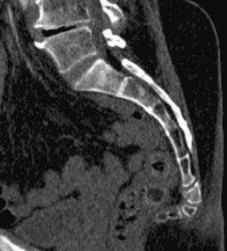 Intercoccygeal angle and type of coccyx in asymptomatic patients ...