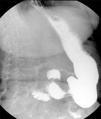 Anatomical classification of the shape and topography of the stomach ...