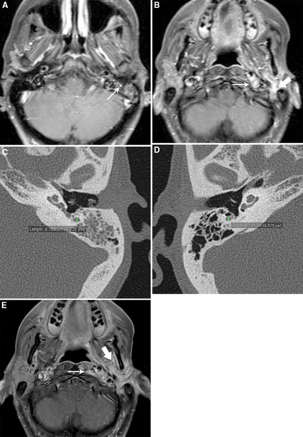 Skull base CT: normative values for size and symmetry of the facial ...