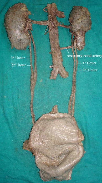 Bilateral bifid ureter with unilateral renal vasculature variations ...