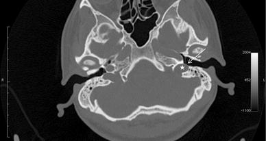 High and dehiscent jugular bulb: clear and present danger during middle ...