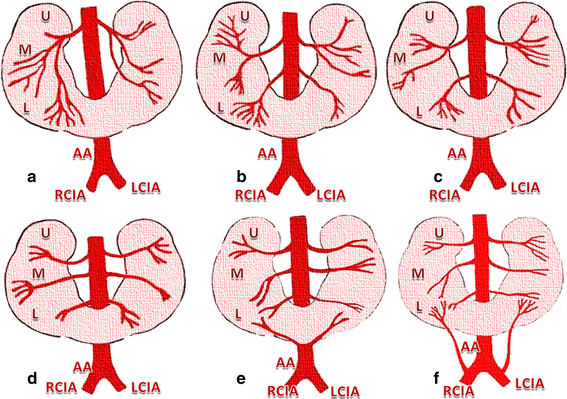 Horseshoe kidney: a review of anatomy and pathology | SpringerLink