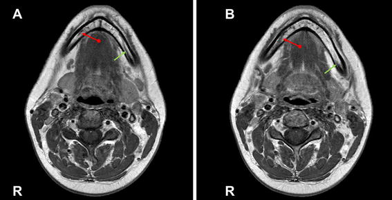 Visualization techniques of the inferior alveolar nerve (IAN): a ...