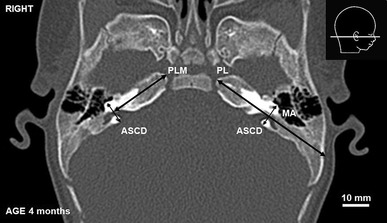 Postnatal development of the subarcuate fossa and subarcuate ...
