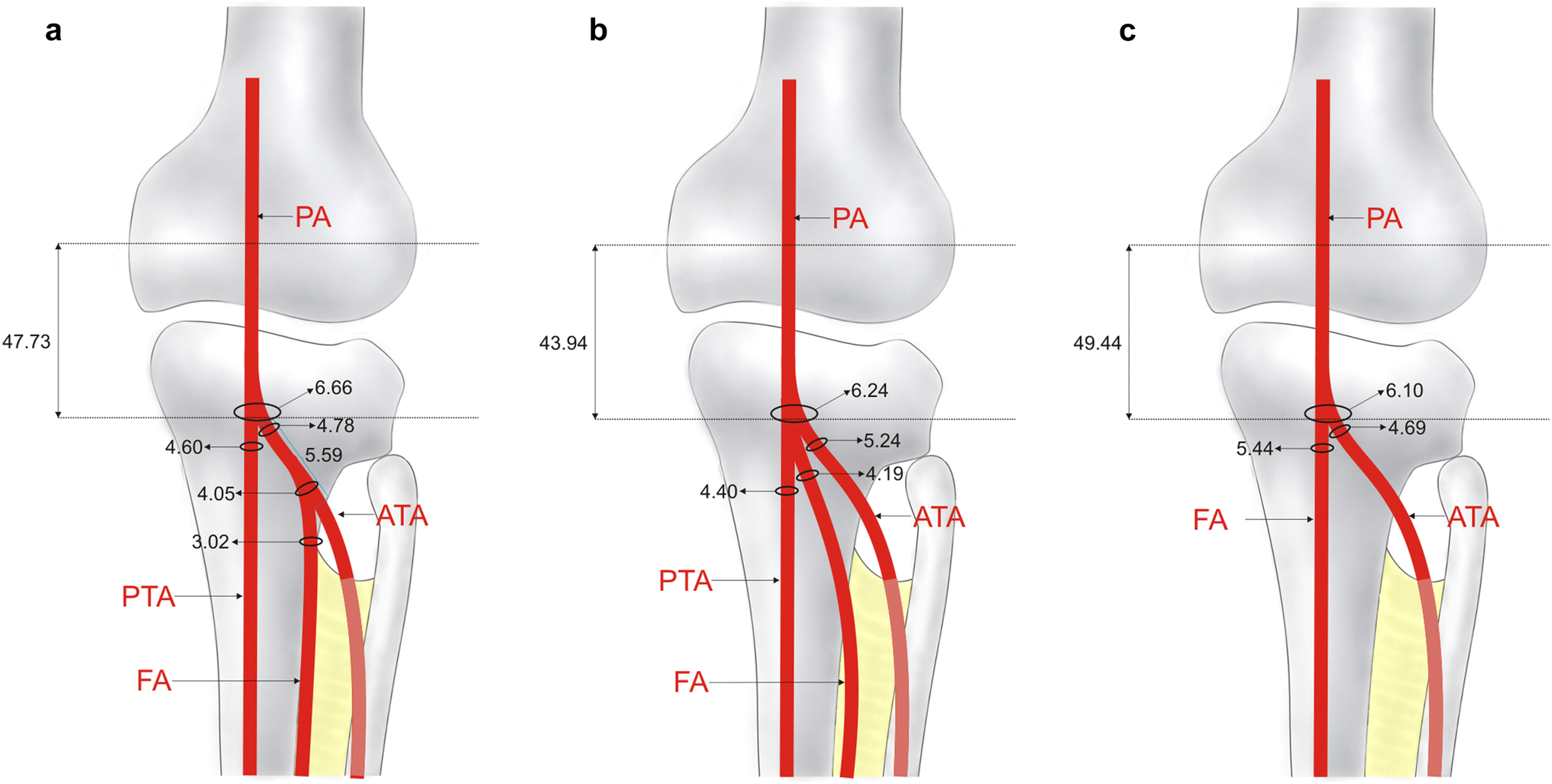 Variations in terminal branches of the popliteal artery: cadaveric ...