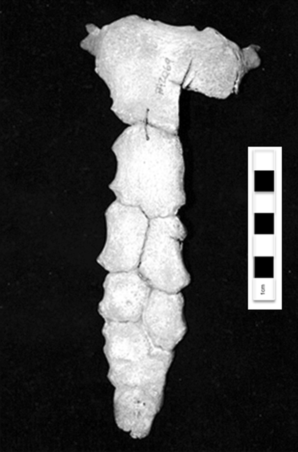 Honeycomb sterna: an unusual case of a developmental abnormality in the ...