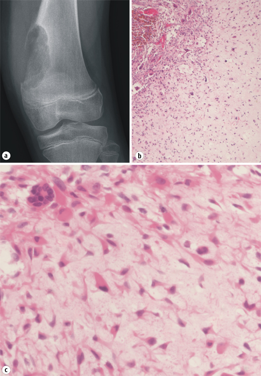 Chondrogene Tumoren des Skeletts | SpringerLink