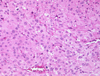 Differenzialdiagnose intramedullärer Osteosarkome | SpringerLink