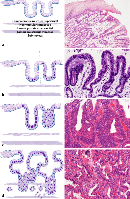 Barrett-Ösophagus | SpringerLink