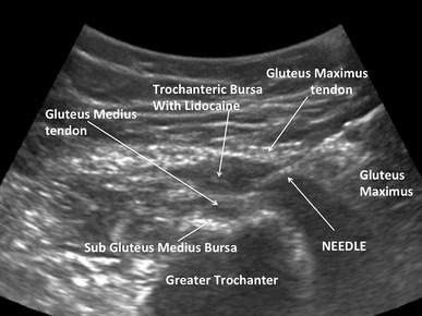 Outcomes and cost-effectiveness of ultrasound-guided injection of the ...