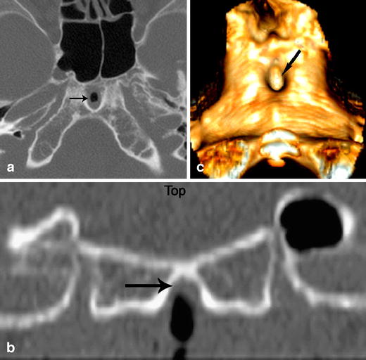 Imaging of nasopharyngeal cysts and bursae | SpringerLink