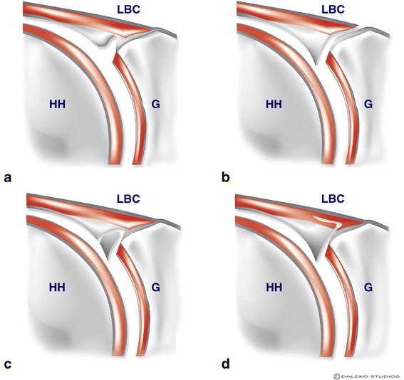 MR imaging in sports-related glenohumeral instability | SpringerLink