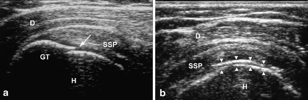 Double line sign: a helpful sonographic sign to detect occult fractures ...