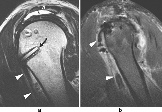 Multimodality imaging of the postoperative shoulder | SpringerLink