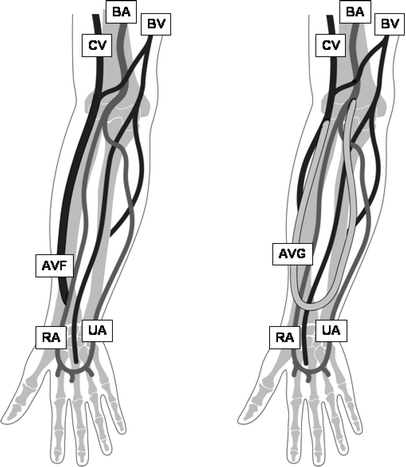 Current techniques for assessment of upper extremity vasculature prior ...