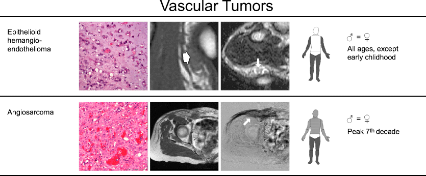 Soft tissue sarcomas at a glance: clinical, histological, and MR ...