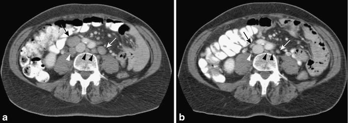 RECIST revised: implications for the radiologist. A review article on ...