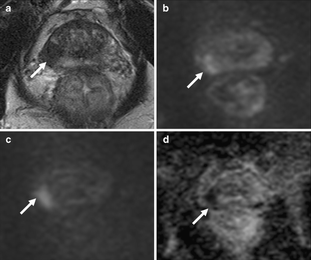Diffusion weighted imaging in prostate cancer | SpringerLink