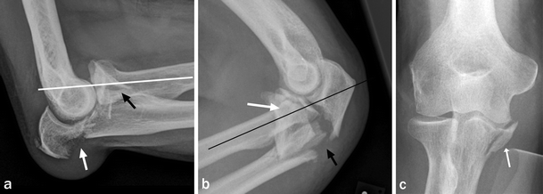 Traumatic instability of the elbow - anatomy, pathomechanisms and ...