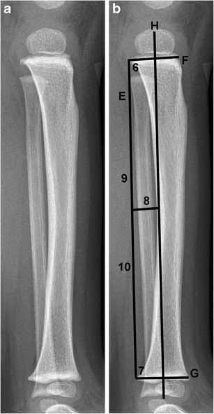 Tibial bowing in children - what is normal? a radiographic study ...