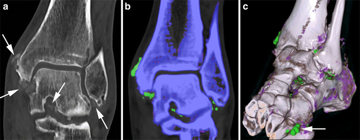 Gouty arthritis: the diagnostic and therapeutic impact of dual-energy ...