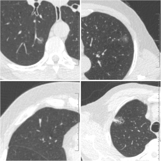 Fleischner recommendations for the management of subsolid pulmonary ...