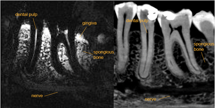 Magnetic resonance imaging of intraoral hard and soft tissues using an ...