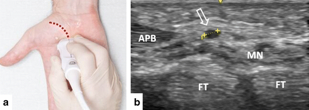 High-resolution ultrasound visualization of the recurrent motor branch ...