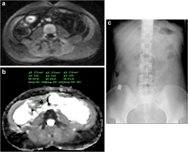Assessment of patency capsule retention using MR diffusion-weighted ...