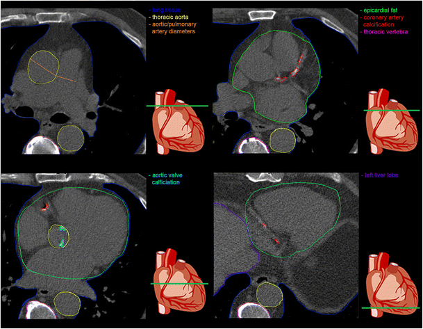 Leveraging the coronary calcium scan beyond the coronary calcium score ...